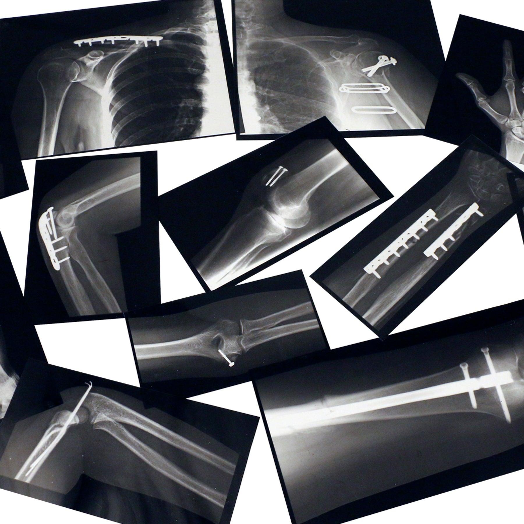 Fixed Bones X-Ray Set - Loomini